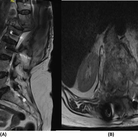 A T2 Weighted Sagittal Lumbar Spine Mri Demonstrating A Pathological