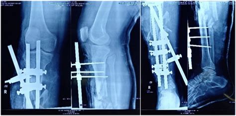 Combined Ortho Surgical Approach Based On Ilizarov External Fixator During Management Of A