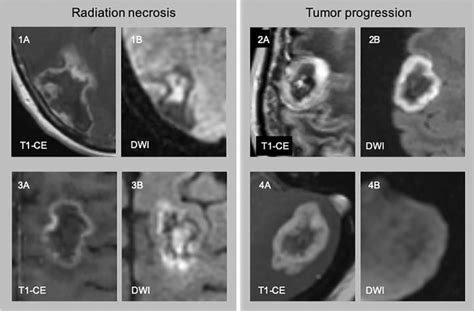 The Centrally Restricted Diffusion Sign On Mri For Assessment Of Radiation Necrosis In