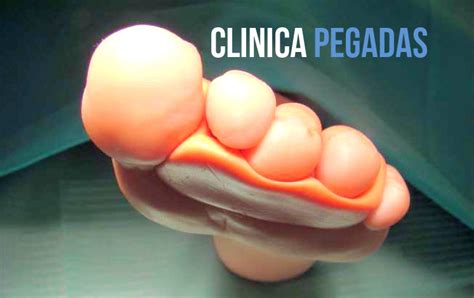 Ortesis De Silicona Información Y Recomendaciones Clínica Pegadas