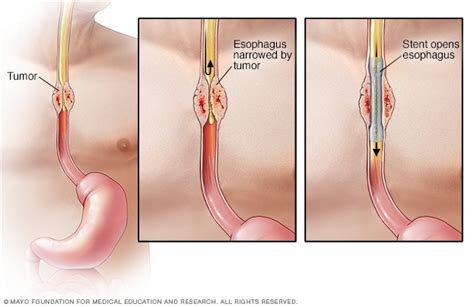 Esophageal Stent Mayo Clinic