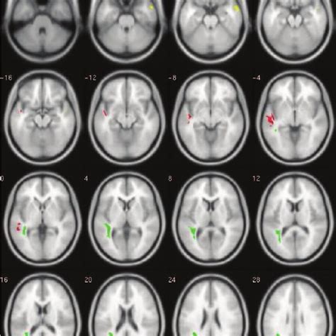 Significant Clusters Of Relatively Decreased Gray Matter Volume Download Scientific Diagram