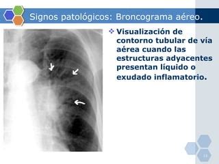 Radiografía De Tórax Ppt