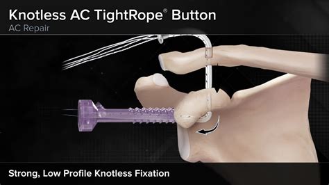 Arthrex Knotless Ac Tightrope® Button