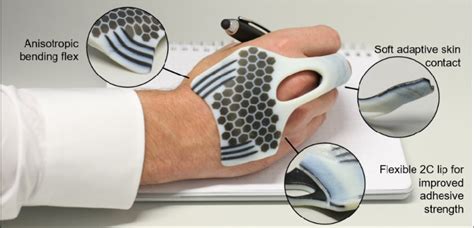 16 3d Printed Hand Splint Fixed With Double Sided Tape Reiter 2016