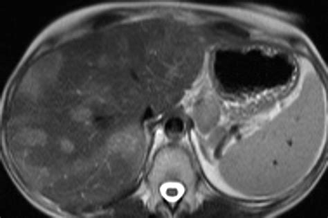 Expected And Unexpected Imaging Findings After 90y Transarterial