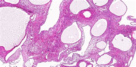 Pathology Outlines Mixed Epithelial And Stromal Tumor