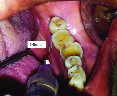 Inferior Alveolar Nerve Block Landmarks