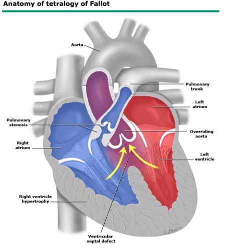 BME 460 Exam 2 Congenital Defects Flashcards Quizlet