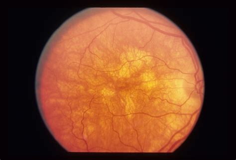 Pattern Dystrophy Retina Image Bank