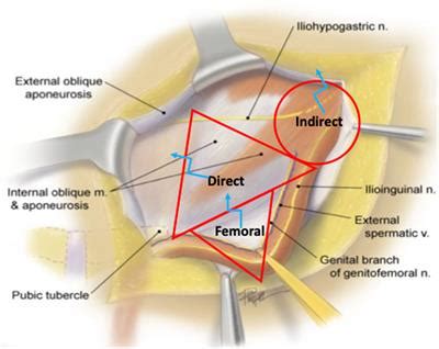 Indirect Inguinal Hernia Anatomy