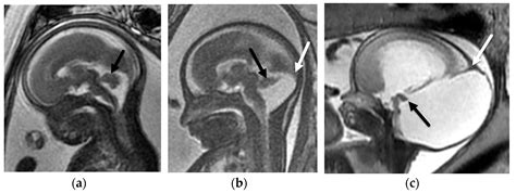Clinical Applications Of Fetal Mri In The Brain
