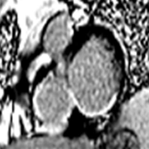 Short Axis Slice Of Right Ventricular Stress Induced Perfusion Defect