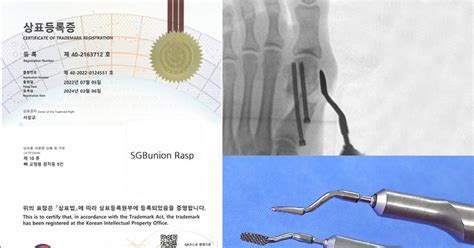Snu서울병원이 쓰는 무지외반증 수술 기구는 다르다 기술력 인정받아 특허 취득