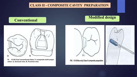 Class I Ii Composites Cavity Preparations Ppt Class I Ii Composites Cavity Preparations Ppt