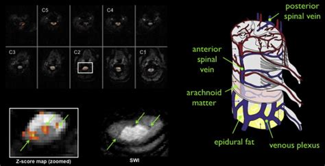Spinal Cord Fmri Radiology Key