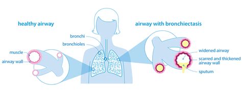What Is Bronchiectasis And How Is It Caused Asthma Lung Uk