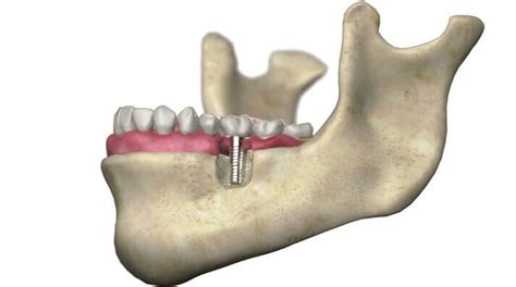 Osteonecrosis Of The Jaw Causes Symptoms And Treatment