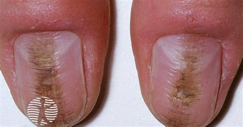 Habit Tic Nail Deformity Image
