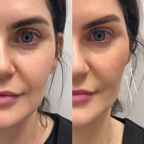 What Is Threading Botox At Genevieve Horton Blog