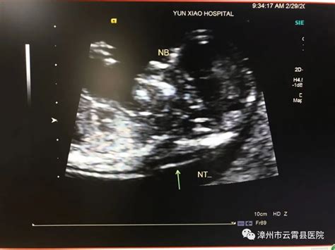 超声nt标准切面图 Nt测量标准切面超声图 第6页 大山谷图库
