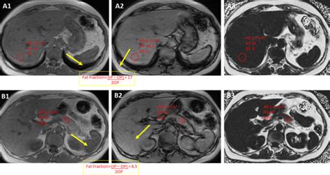 Example Of Fat Quantification In Liver A And Pancreas B On Download Scientific Diagram