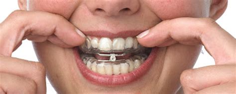 5 Best Mandibular Advancement Device For Sleep Apnea 2024
