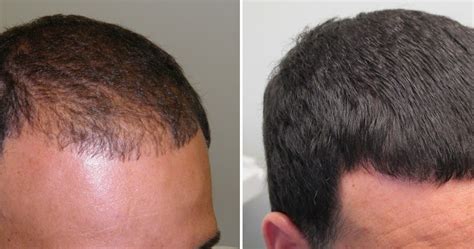 Does Age And Sex Matters In Hair Transplant