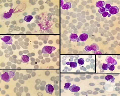Plasma Cell Dyscrasia