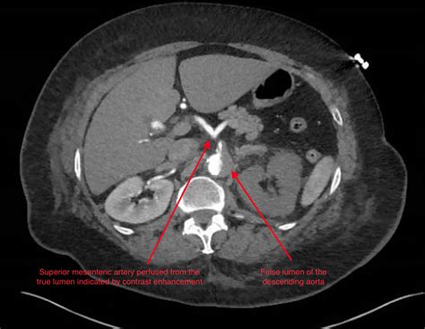 Renal Infarction From Type B Aortic Dissection Ct Axial Annotated 2a