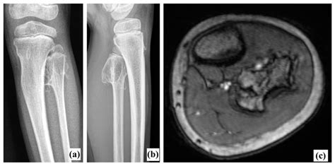 Preoperative X Rays Ab And Mri C Anterior Tibial Artery And