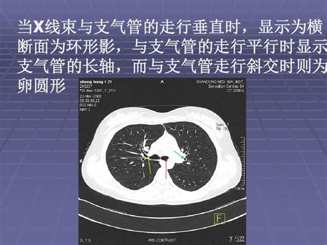 正常胸肺部ct影像学表现word文档在线阅读与下载无忧文档
