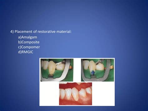 Class V Restoration Operative Pptx