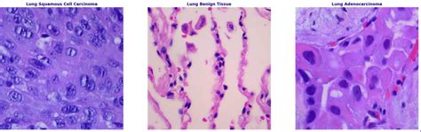 Samples Of The Lung Cancer Histopathological Images Dataset Download