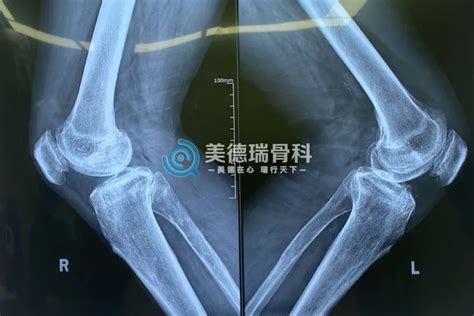 翁牛特妇幼保健院美德瑞骨科中心多台人工膝关节表面置换术，帮助老年人摆脱行动不便！ 北京美德瑞骨科医生集团官方网站