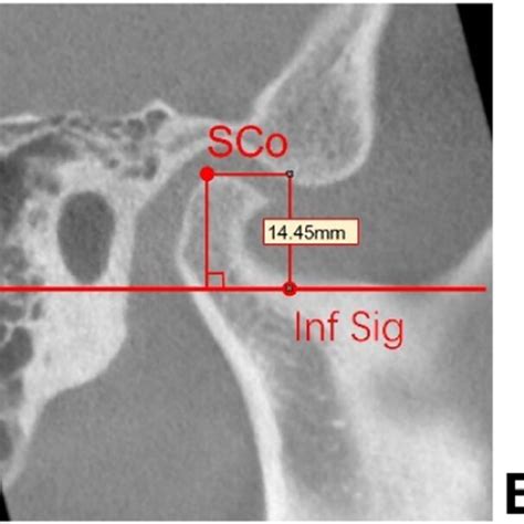 Measurement Of The Length Width And Height Of Condyle A Condylar