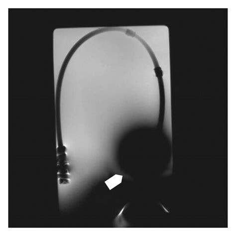 A Coronal Fast Gradient Echo T1 Weighted And B Coronal Fast Download Scientific Diagram