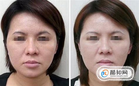 打肉毒素除皱多久才能见效 酷知经验网