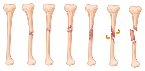 Tibia Fractures Types Symptoms Treatments Heiden Orthopedics