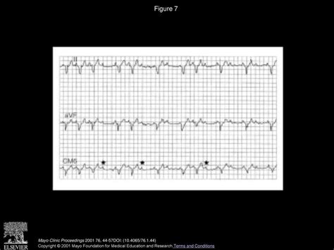 Second Degree Atrioventricular Block A Reappraisal Ppt Download