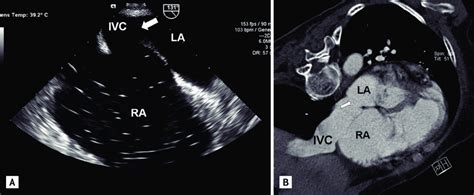 A Transesophageal Echocardiography A Cm Sized Interatrial