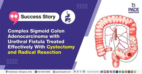 Sigmoid Colon Cancer With Urethral Fistula A Surgical Success