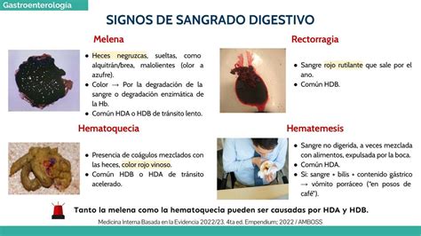 Signos De Sangrado Gastrointestinal Alejandro Udocz