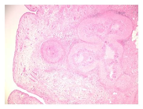 A Low Power Hande Stain Of Synovial Specimen Demonstrating