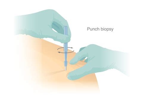 Small Fiber Neuropathy Causes And Treatment Artofit