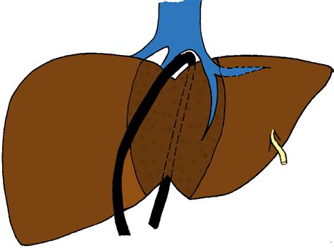 Segmental Oriented Liver Surgery Intechopen