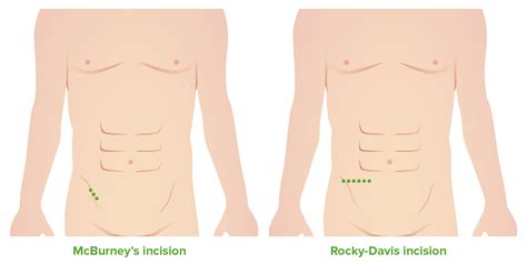 Appendectomy Concise Medical Knowledge