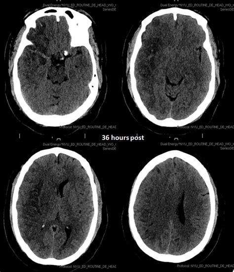 Case Archives Stroke Ct Vs Ct Perfusion