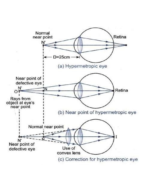 Hypermetropia Pdf