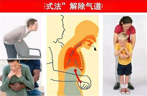 人人必会的急救知识：解救异物卡喉的海姆雷克手法 搜狐大视野 搜狐新闻